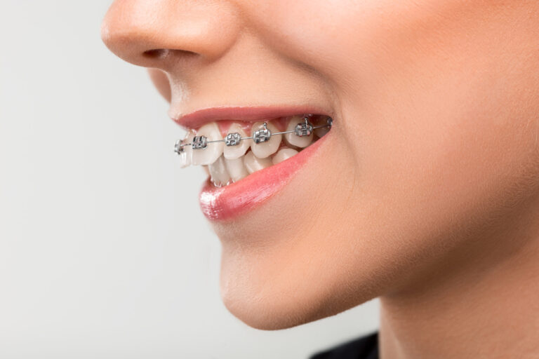 Overbite vs. Buck Teeth: How Do I Fix It? | B Orthodontics